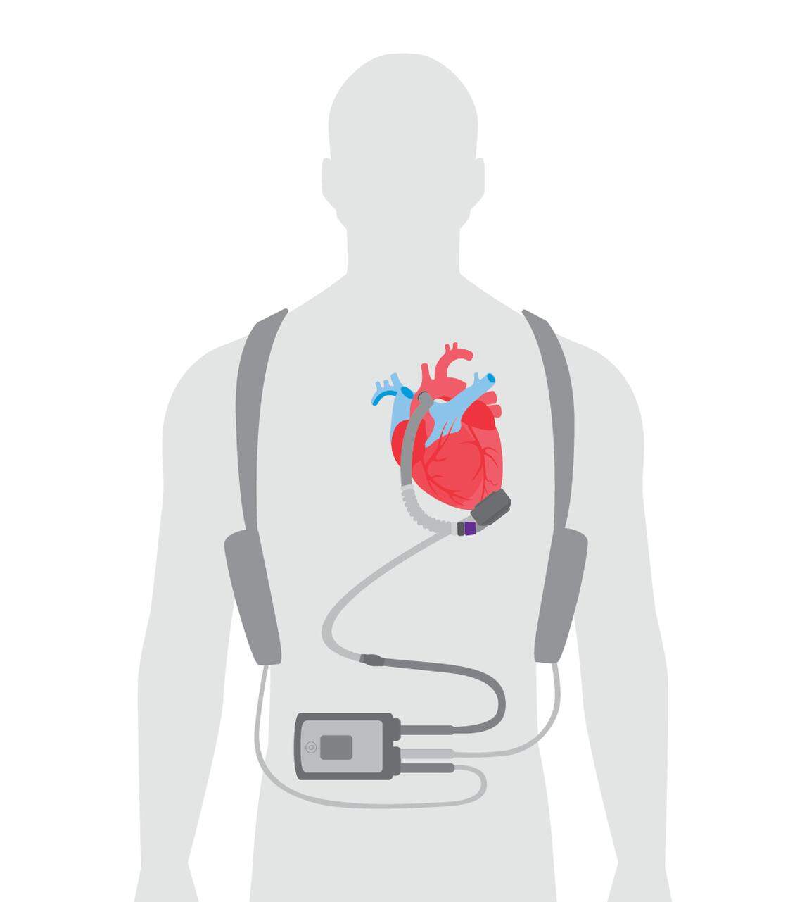 What are the benefits, risks of heart pump implants? | Miami Herald